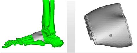 Bone Disintegration Charcot Neuroarthropathy