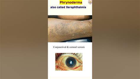 Vitamin A Deficiency Phrynoderma Cause Symptoms And Treatment Skin Disease Youtube