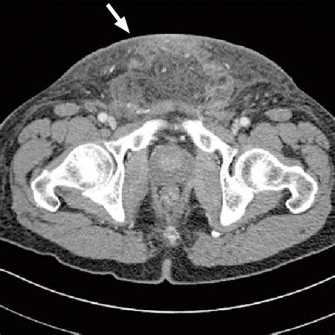 Contrast Enhanced Computed Tomography Scan Diffuse Soft Tissue