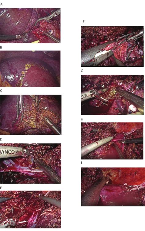 Video Laparoscopic Anatomical Right Hemihepatectomy Via The In Situ Anterior Approach