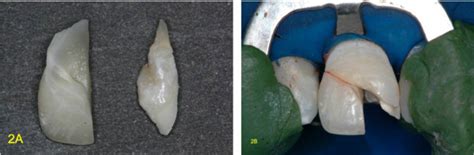 A Crown Root Fragments Fragment Size Favors Adhesive Procedures B