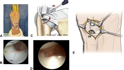 Arthroscopic Assisted Repair Of The Triangular Fibrocartilage Complex Pmc