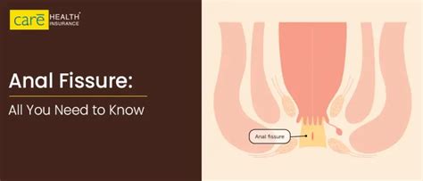 Anal Fissure Symptoms And All You Need To Know