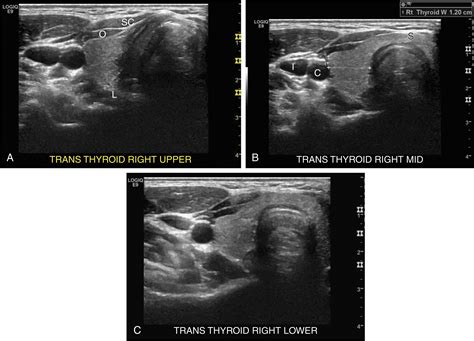 The Thyroid And Parathyroid Glands Clinical Tree