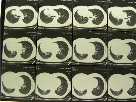 Ct Scan Bilocular Cystic Mass 15 × 9 5 Cm At Its Maximum Diameter In Download Scientific