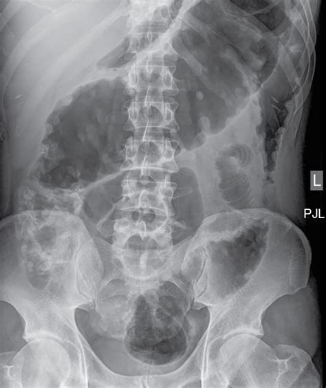 Normal Abdominal X Ray