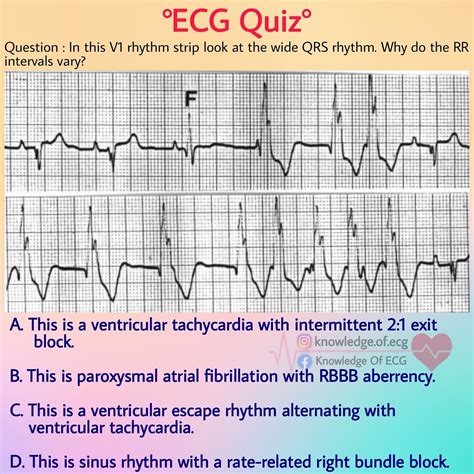 Atrial Flutter Rhythm Strip