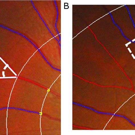 Measurement Of Retinal Vascular Calibre Using Color Fundus Photographs Download Scientific