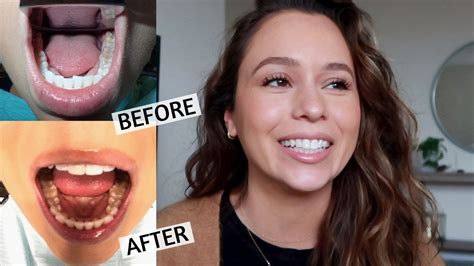 Invisalign Before And After What You Can Achieve Simply Teeth Essex