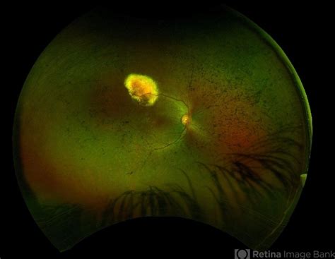 RP With VPT Retina Image Bank