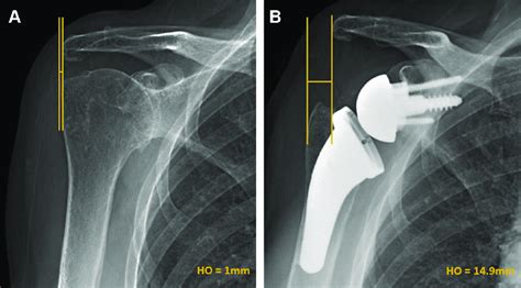 Preoperative Humeral Offset A And Postoperative Offset B Were Download Scientific Diagram