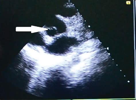 Epistaxis As The Initial Presentation In A Case Of Rheumatic Heart