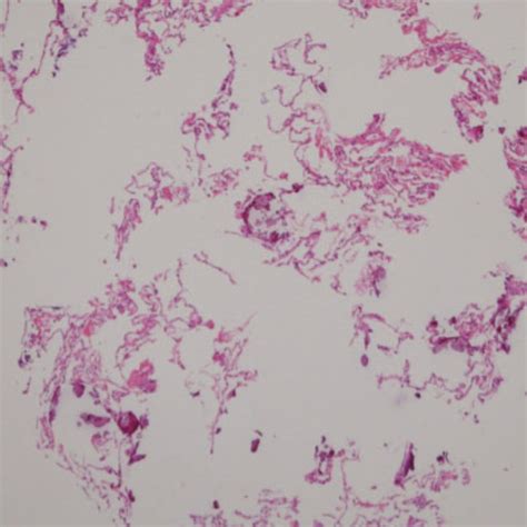 Chest Radiograph Shows Bilateral Fine Reticular Nodular Shadowing In