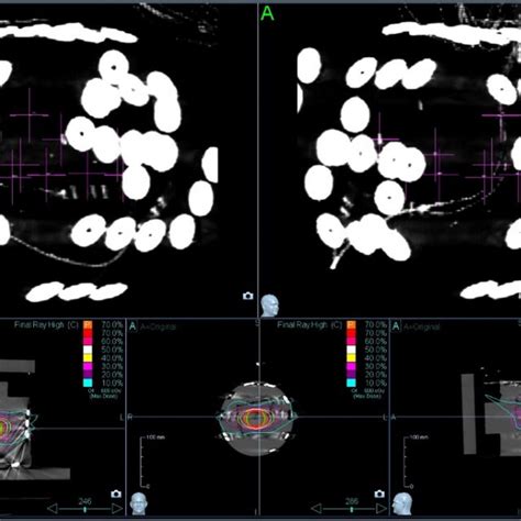 Data File From The Tumor Treating Fields Ttfields System Shows That