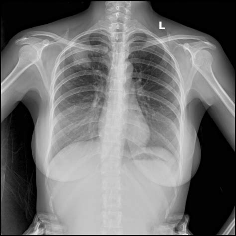 Kaggle Cxr Images Object Detection Dataset By Cxr Abnormality Detection