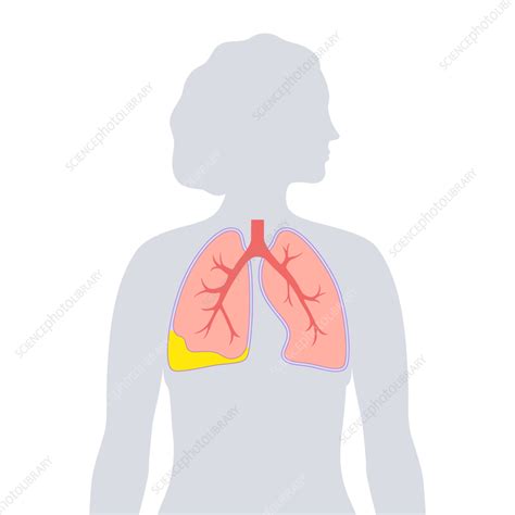 Pyothorax Definition