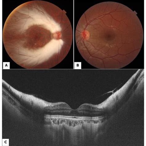 fundus examination of both eyes and sd oct scan a right eye re