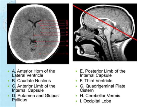 Normal Brain Ct Scan Vs Hydrocephalus Explained Pptx Brain And