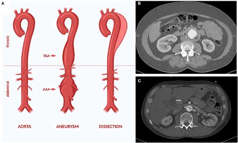 type b dissection management