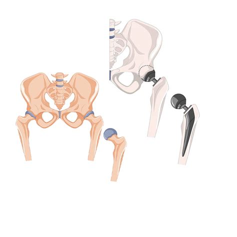 Joint Reconstruction Ortho And Gynae Health