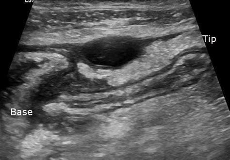 Ruptured Appendix Ultrasound