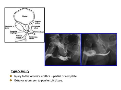 Retrograde Urethrogram Presentation 1 Ppt Pptx