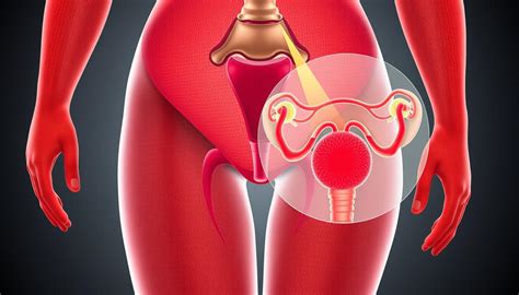 Can Fibroids Cause Urinary Tract Infections Learn More