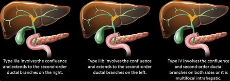 Cholangiocarcinoma Staging