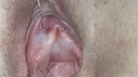 Electrasexual Cries Of Pain Injecting Clit ManyVids