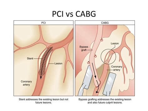 Long Term Stroke Rate Higher With Cabg Vs Stenting Faculty Of Medicine