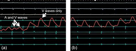 Example Tracings From A Cryoballoon Ablation Of The Right Superior Download Scientific Diagram