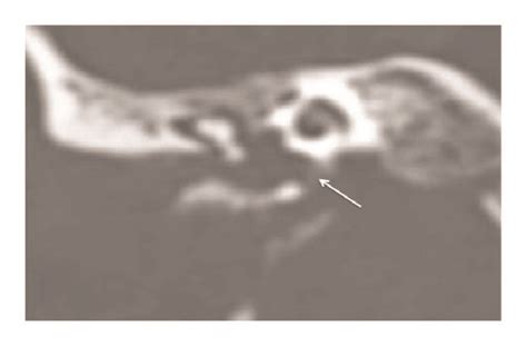 A The 3d Volume Rendering Technique Shows The Lateral Surface Of The