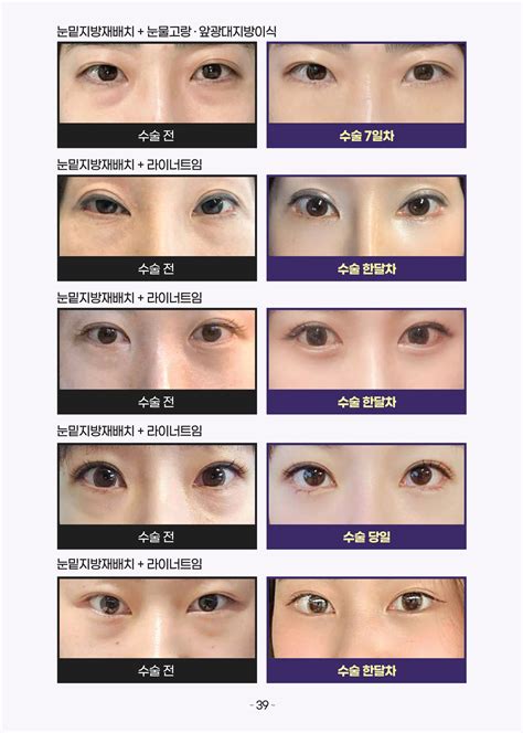 아몬드성형외과 눈밑지방재배치 안검하수 눈매교정 쌍꺼풀 쌍꺼풀수술 쌍수 자연유착쌍꺼풀 앞트임 안검하수수술 눈매교정수술전후 쌍꺼풀재수술
