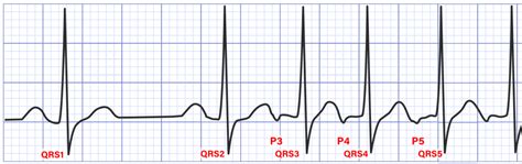 A Rational Approach To The Diagnosis Of Narrow Complex Tachycardia Auctores