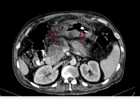 Shows Minimal Fat Stranding Around The Pancreas Download Scientific