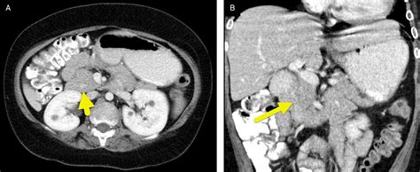 Annular Pancreas Applied Radiology