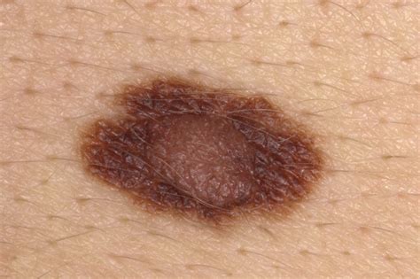 Differential Diagnoses Pigmented Skin Lesions Gponline