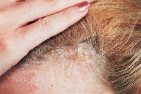 Mild Scalp Psoriasis Symptoms