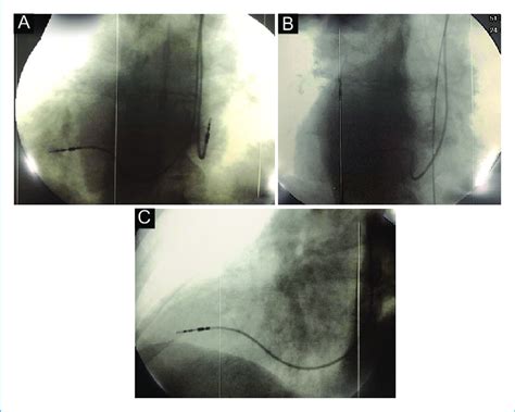 Disposición De Los Electrodos Durante El Implante Imágenes De
