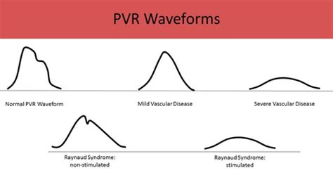 Vascular Boards To Know Flashcards Quizlet