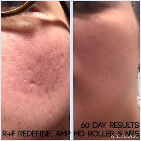 Acne Pockmarks Before And After At Mark Dunning Blog