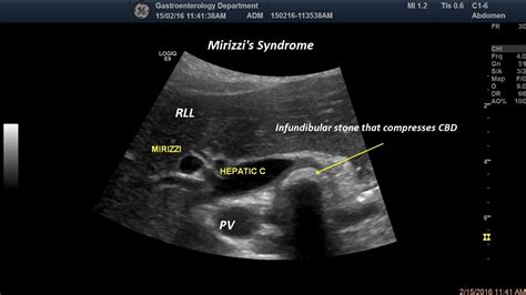 Mirizzi Syndrome 1 Image Efsumb