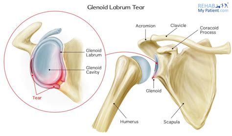 Glenoid Labrum Tear Rehab My Patient