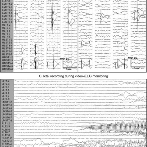 Intracranial Eeg Recordings From Patient 3 A Interictal Ieeg