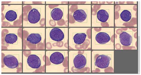 Hematology Case Study 75 Year Old Man With Leukopenia Lablogatory Hematology Case Study 75 Year Old Man With Leukopenia Lablogatory