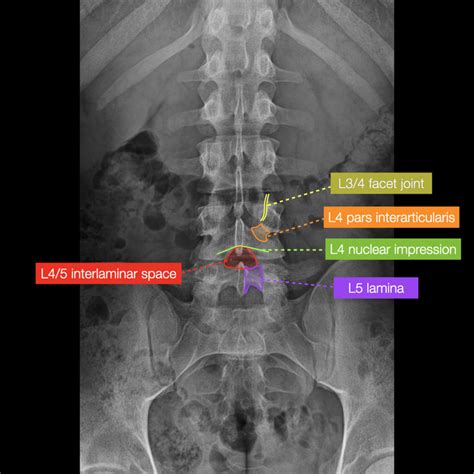 Facet Joints Anatomy