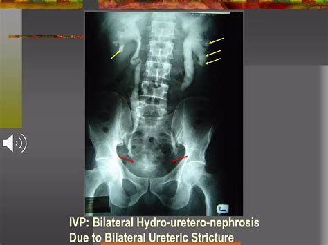 Obstructive Uropathy Online Pptx