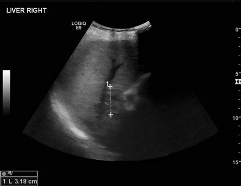 Cholangitis Ultrasound