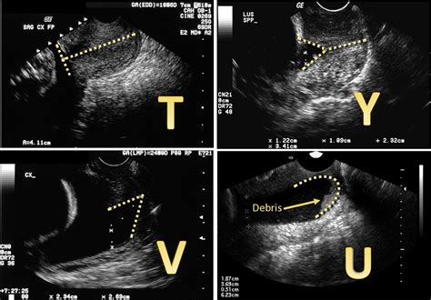 The Short Cervix Obstetrics And Gynecology Clinics