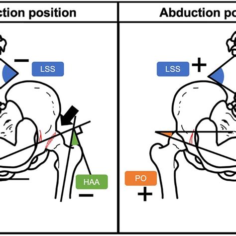 Preoperative And Postoperative Lumbo Pelvic Radiographs The